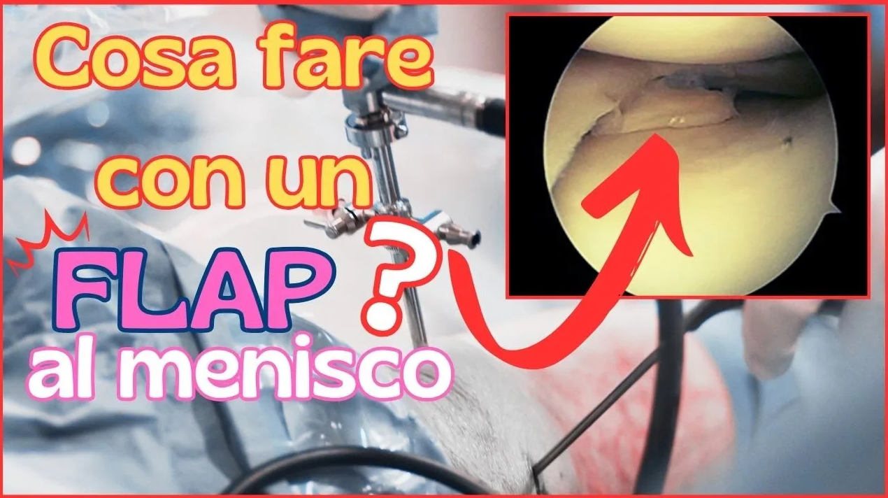 Lesioni a Flap del Menisco: Cosa Sono e Come Affrontarle - Francesco ...